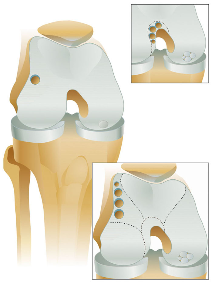 Knorpel-Knochen Transplantation - QKG
